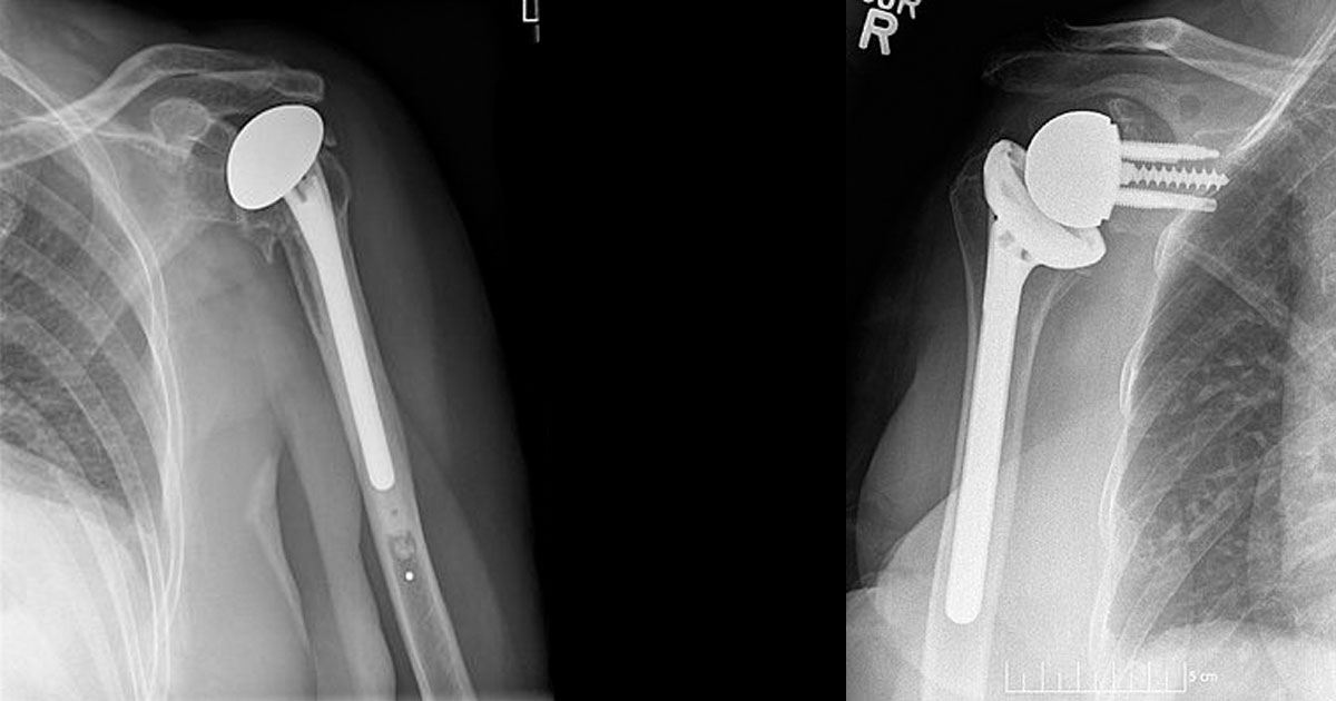 Total Shoulder Arthroplasty Total Shoulder Arthroplasty