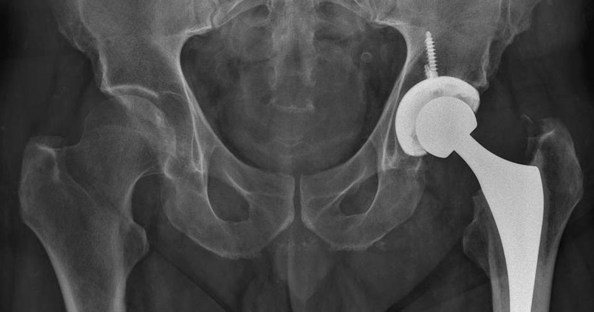 Total Hip Arthroplasty Replacement 